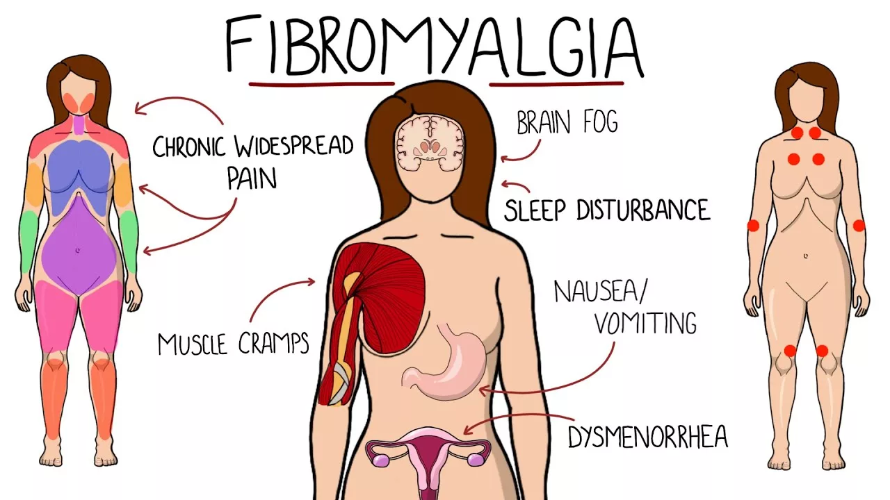 What is Fibromyalgia? What are the Symptoms of Fibromyalgia?